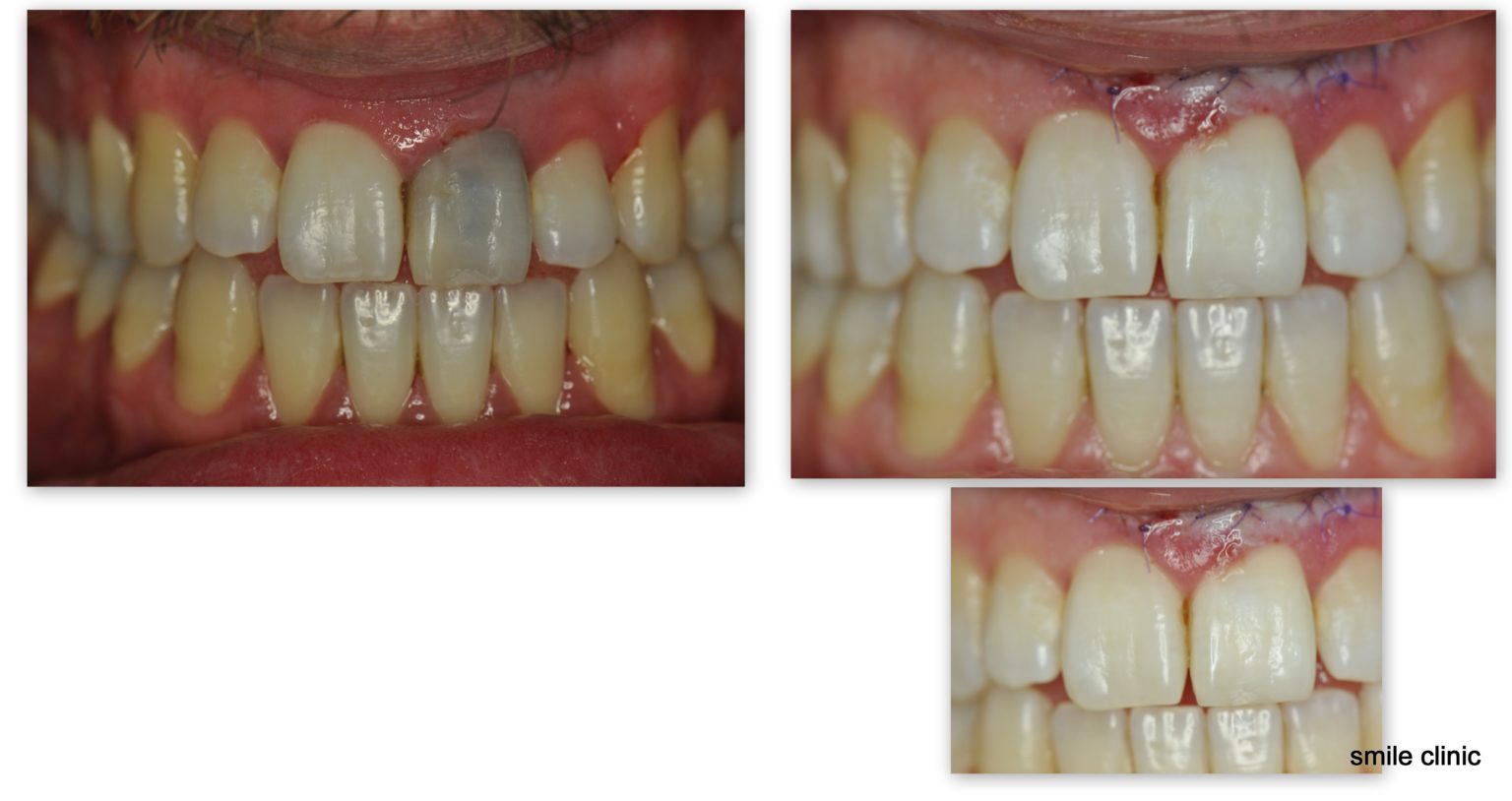 Do you have a grey tooth that bothers you? SMILE DENTAL IMPLANT CLINIC